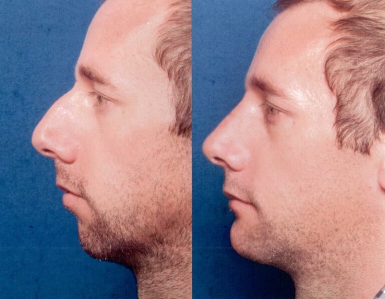 The Authenticity And Popularity Of Chin Surgery In Men - Healthy Wix